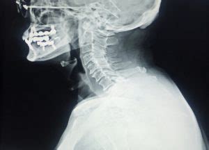 Do Bone Spurs In Neck Cause Facial Swelling Premier Ortho