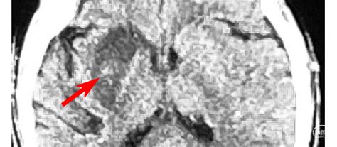 你会把 脑出血”诊断为 脑梗死”吗？ 脑医汇