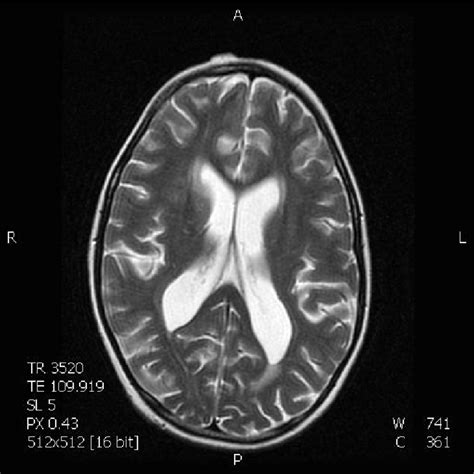 Suprasellar Arachnoid Cyst T2 Weighted Se Image Shows A Cystic Download Scientific Diagram
