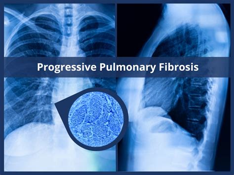 Pulmonary Fibrosis Xray