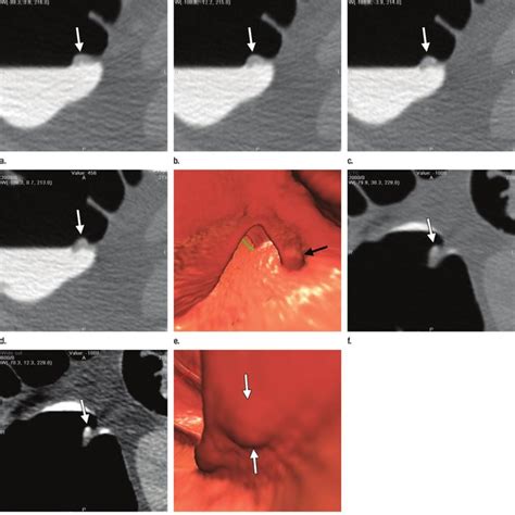 An 8 Mm Polyp Arrow Located In The Ascending Colon Was Visible Only Download Scientific