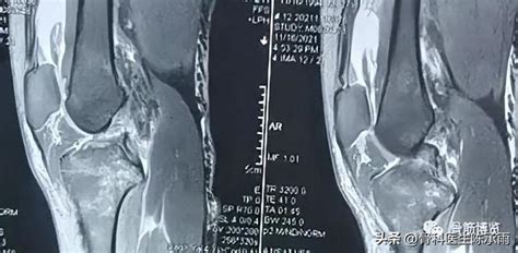 膝關節多發韌帶損傷合併外側半月板撕裂一期關節鏡下修復 伊人小築