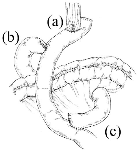 Figure 1 From Laparoscopic Double Tract Reconstruction After Total Gastrectomy For Postoperative