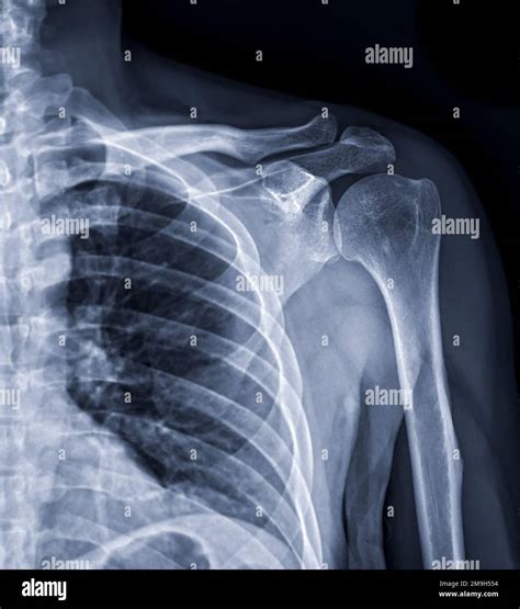 Lateral X Ray Dislocation Of Shoulder At Peggy Bradley Blog