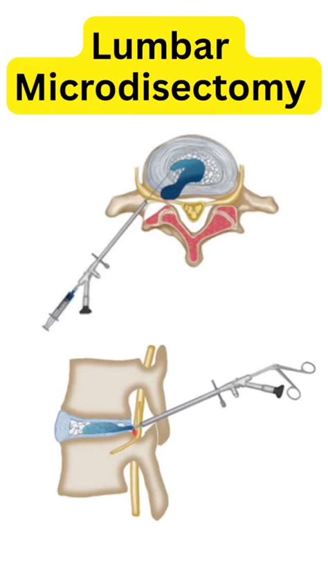 Spinal Cord Microdiscectomy Complications