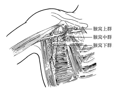三腋窝淋巴结的引流区域及分群 肿瘤外科手术 医学