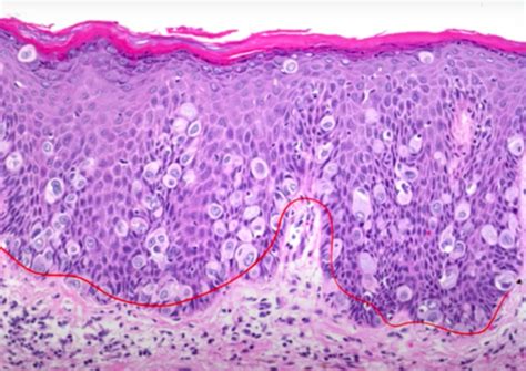 Pathoma Ch 13 Female Genital System Flashcards Quizlet