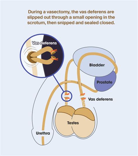 Vasectomy Bay Area Vasectomy Silicon Valley Urologist Dr