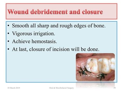 Impacted Third Molar And Management Ppt