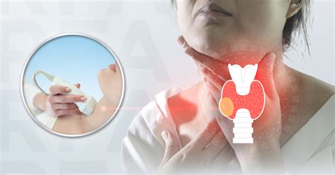 Thyroid Radiofrequency Ablation Package A Minimally Invasive Treatment For Thyroid Nodules