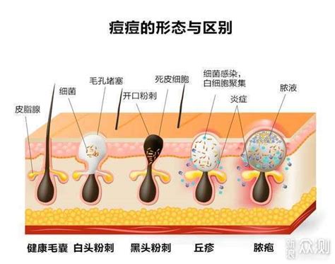 别再用手挤痘痘了，手把手教你如何护理痘痘肌原创新浪众测