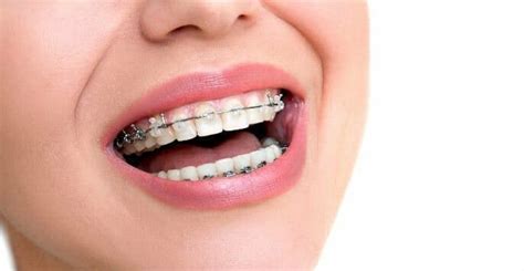 How Are Diamond Braces Different From Traditional Braces Brodie