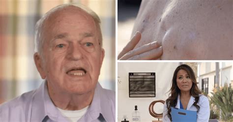 Where Is Ralph Now Dr Pimple Popper Gives Patient Who Is A Cyst Factory Hope After 6 Failed