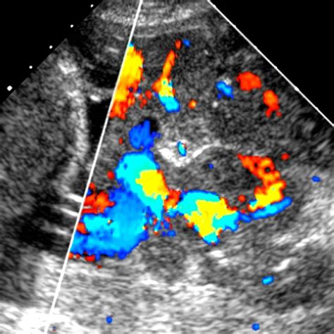 Chorioangioma Radiology Key