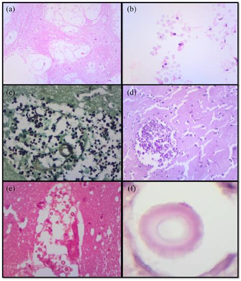 A F Cryptococcal Infection A Soap Bubble Appearance And B Download Scientific Diagram