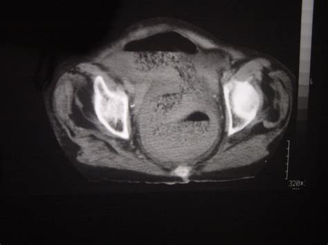 Pseudomembranous Colitis Surgery Photos
