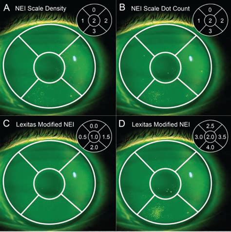 Dry Eye Renaissance Escalating Cases Meet With Innovation