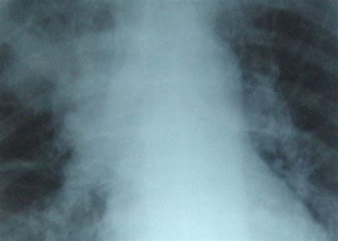 The Proseva Trial Proning In Severe Ards Classics Series 2 Minute