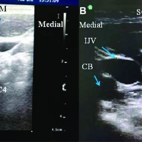 Ultrasound Guided Deep And Superficial Cervical Plexus Block A
