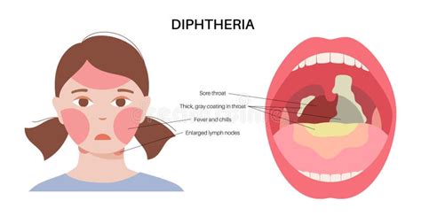 Enfermedad Bucal Por Difteria Ilustración Del Vector Ilustración De