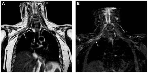 Sensory Motor Demyelinating Neuropathy At Ada Michalski Blog