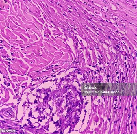 갑상선암 여포성 신생물의 현미경 이미지 비정형 갑상선 여포 상피 세포의 악성 신생물 갑상샘에 대한 스톡 사진 및 기타 이미지 갑상샘 갑상샘암 갑상샘종 Istock