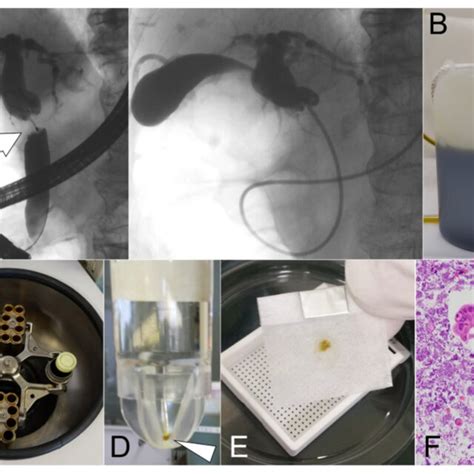 The Comparison Of Malignant Cell Count On The Cell Block Cb And