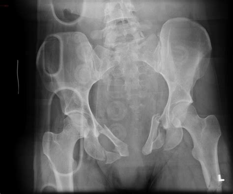 Pelvic Ring Fractures Trauma Orthobullets