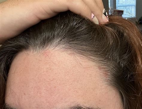 Is This Still Seb Derm R Sebderm