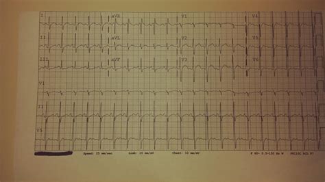 Sinus Tach Vs 3 1 Flutter Ekgs