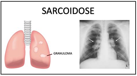 Sarcoidose Medicina De Excelência