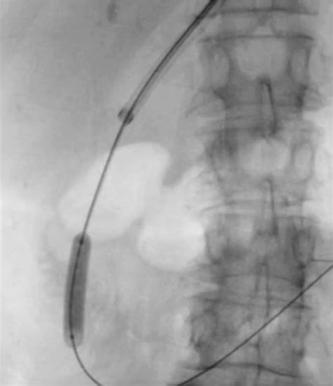 Figure 2 From Percutaneous Transhepatic Cholangioscopy With Intraductal Electrohydraulic