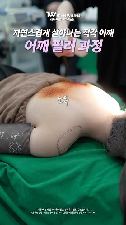 필러로 자연스럽게 살아나는 직각 어깨 라인 어깨 어깨필러 필러 필러시술 시술 시술후기 세가지소원압구정본점 Kbeauty Youtube
