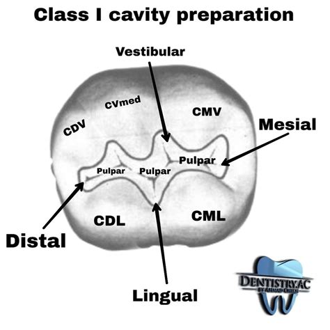 Class I Cavity Preparation In 2025 Dental Assistant Study Dentistry