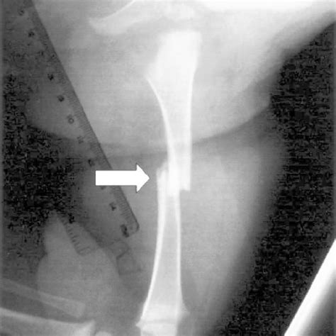 Bone Break Classification Classification Model V2 2024 02 16 437pm