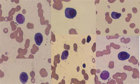 Bone Marrow Aspiration Smears Showing A Lot Of Plasma Cells Wright ×