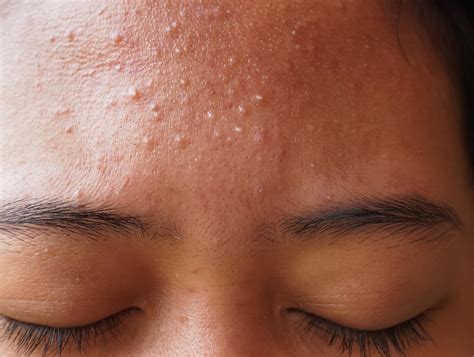 Whiteheads How To Treat And Get Rid Of Them Ducray