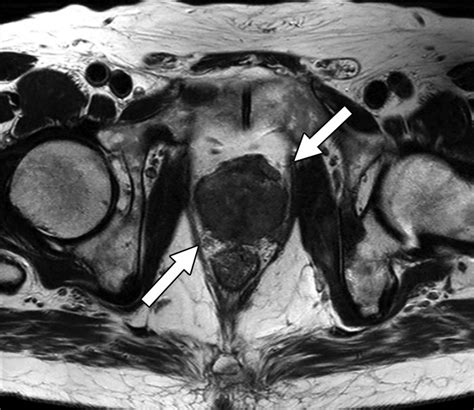 Prostate Most Cancers Bone Marrow Metastasis Monitoring The Response