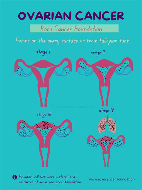 Ovarian Cancer