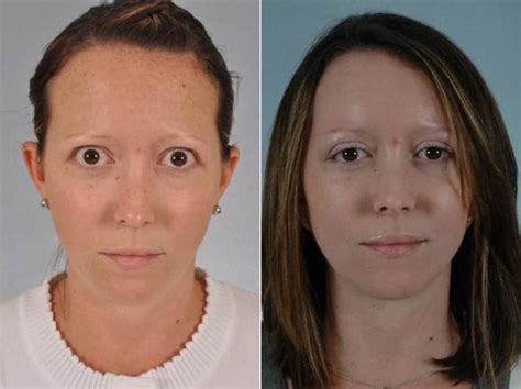 Thyroid Eye Disease Before And After Photos W Cosmetic Surgery