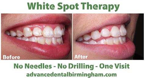 White Streaks On Teeth After Whitening Teethwalls