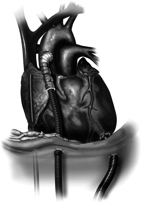 Va Ecmo With Lv Vent Paul Smith