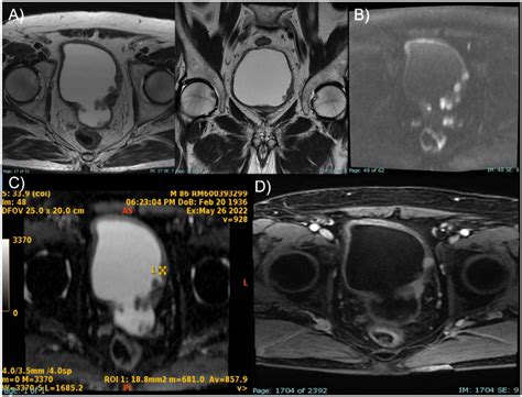 Case Of Multifocal Bladder Tumors With A Vi Rads Overall Score Of 4 A Download Scientific