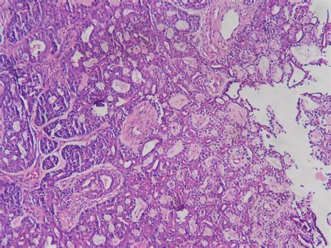 Adenoid Cystic Carcinoma Histopathologyguru