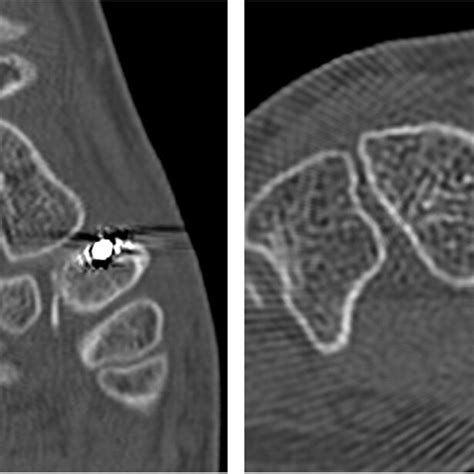 Front Radiographs Of The Wrist Left And Side Radiographs Of The Thumb Download Scientific