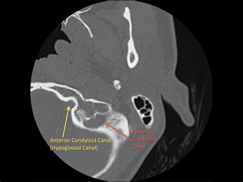Normal Temporal Bone Ct With Annotated Images Radiopaedia 84293 99584