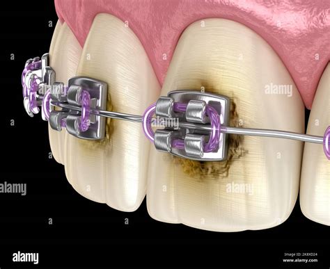 Caries Process Near Braces As Result By Poor Hygiene Medically