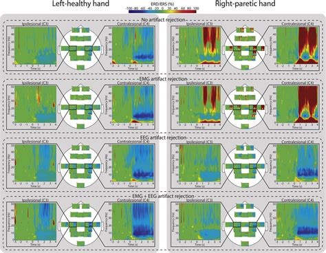 Estimated Cortical Activation With Each Of The Artifact Rejection