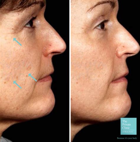 Pixel Laser After Treatment