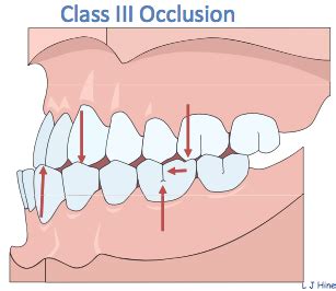 Occlusion Exam 4 Flashcards Quizlet